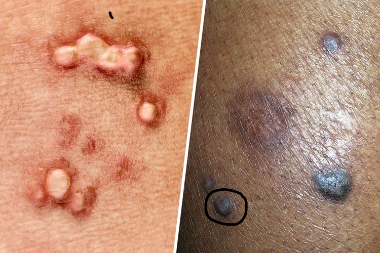 HPV TEDAVISI ANKARA - Doç. Dr. Zeynep Asli Kaplan-07